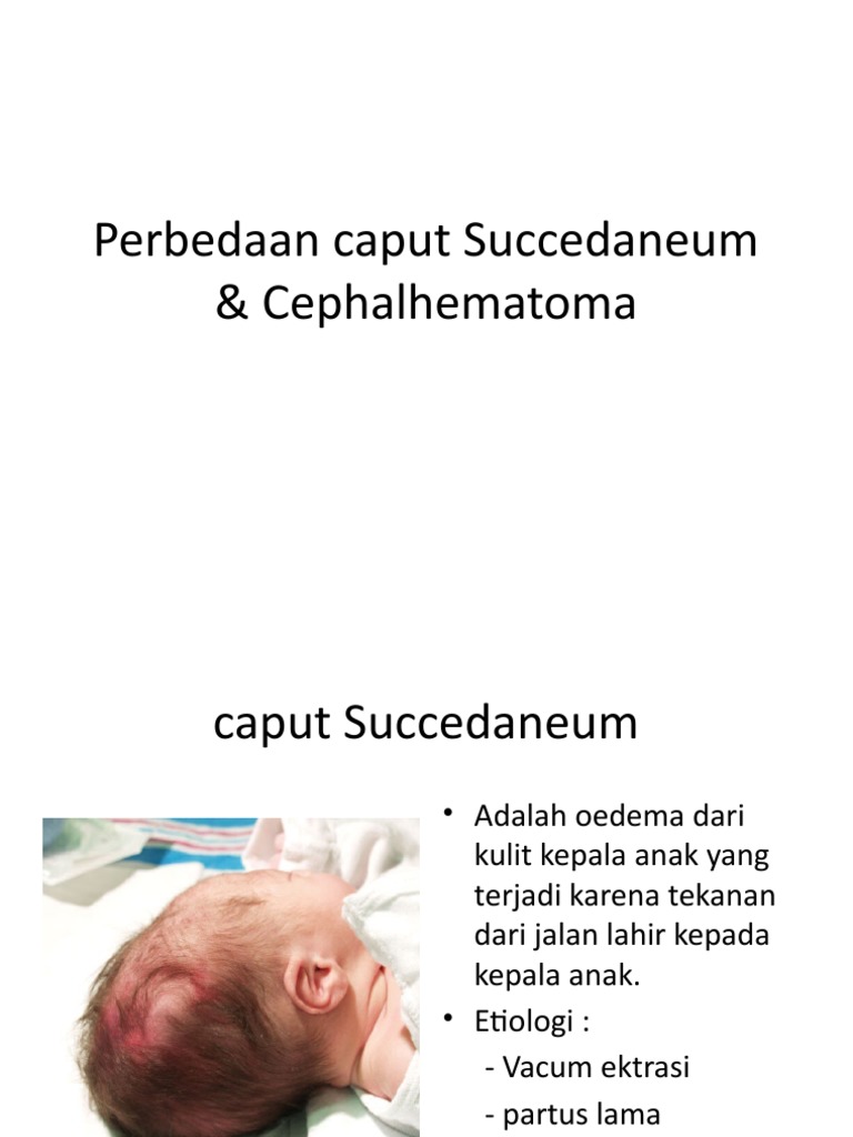 Perbedaan Caput Succedaneum - Cephalhematoma Kel 6 | PDF | Kesehatan ...