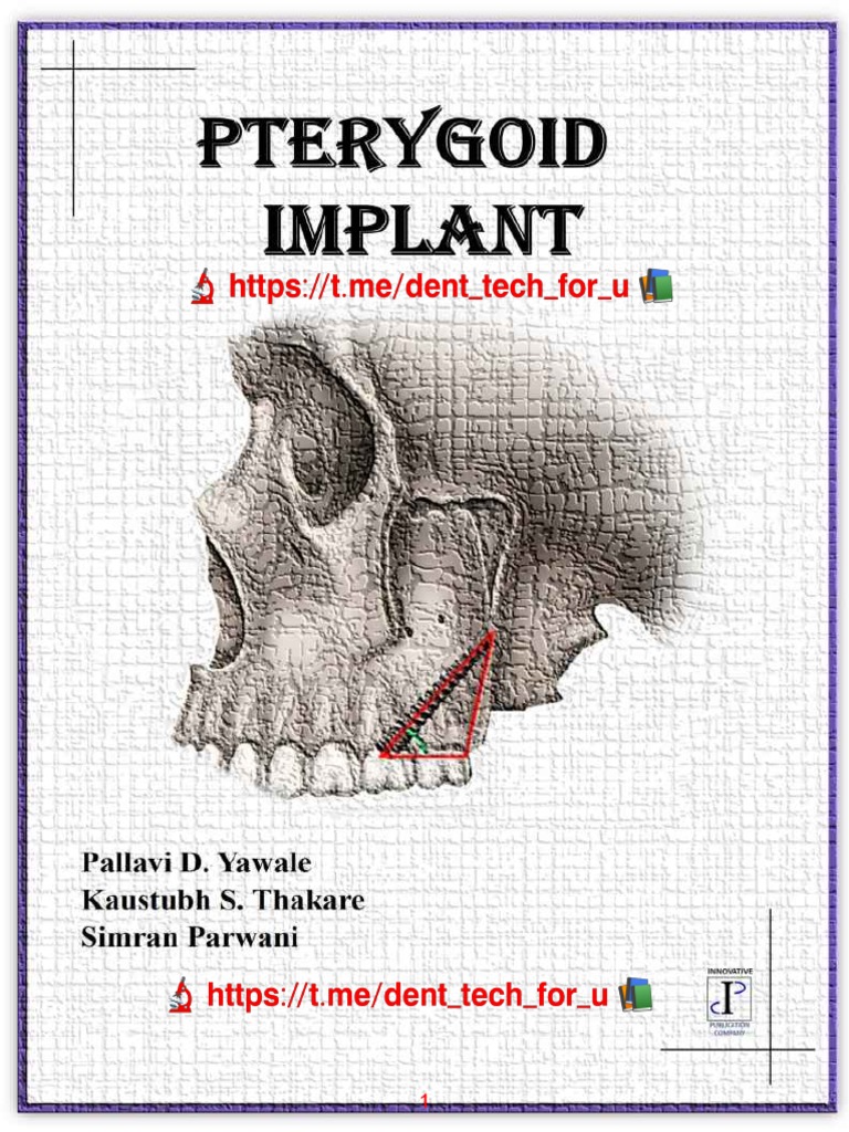 Pterygoid Implant DR Pallavi D Yawale | PDF | Dental Implant | Human ...