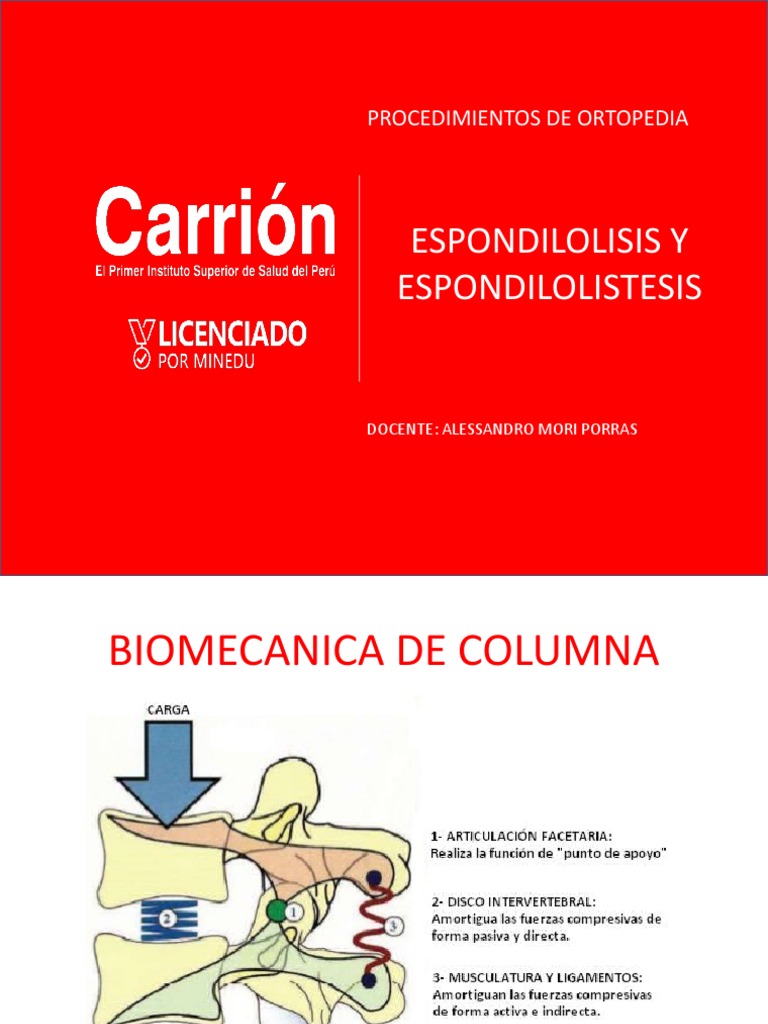 Espondilolisis - Listesis | PDF
