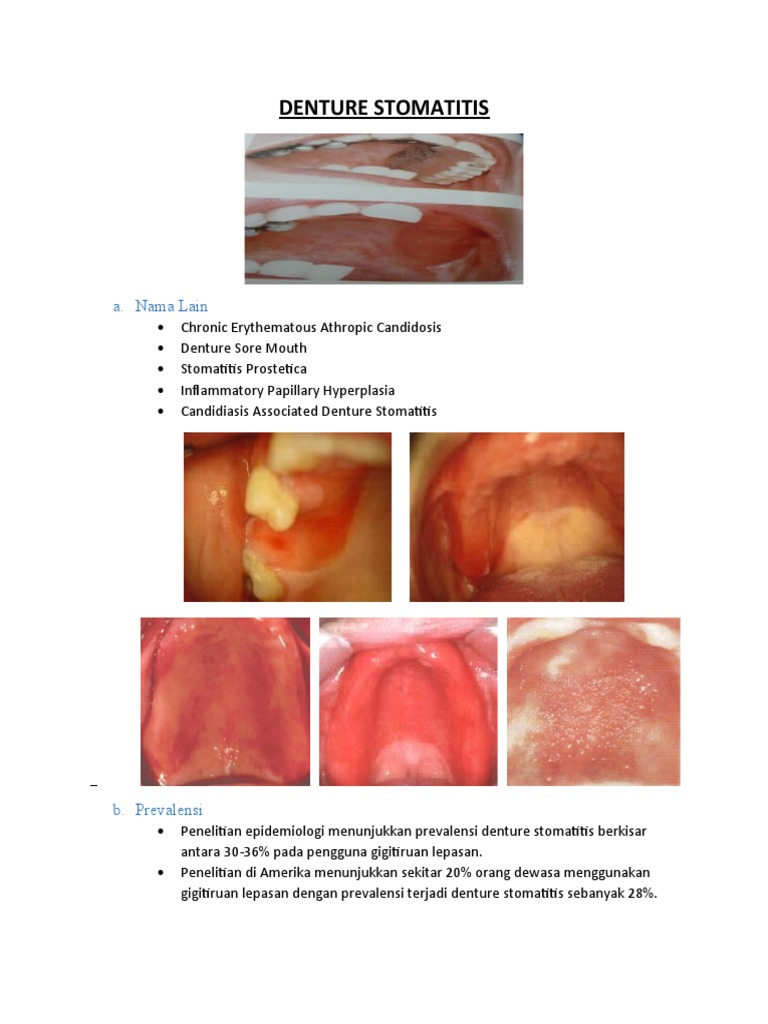 Denture Stomatitis | PDF