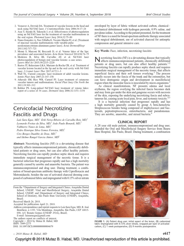Cervicofacial Necrotizing Fasciitis and Drugs: Clinical Report ...