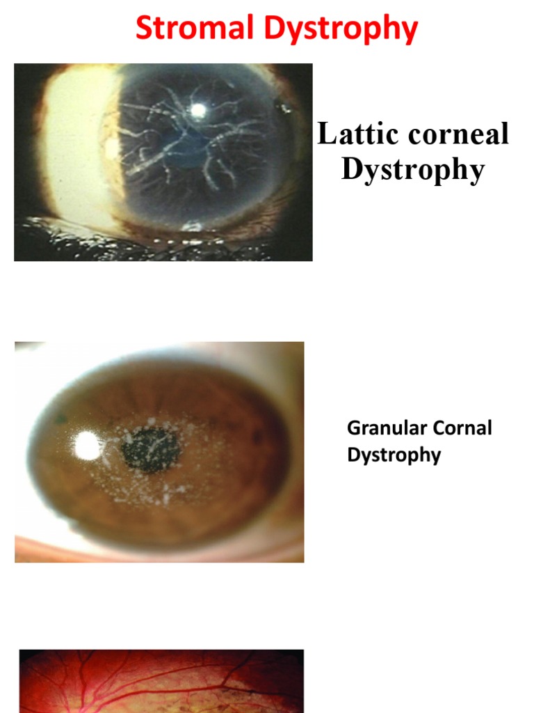 Corneal Dystrophy | PDF | Ophthalmology | Human Eye