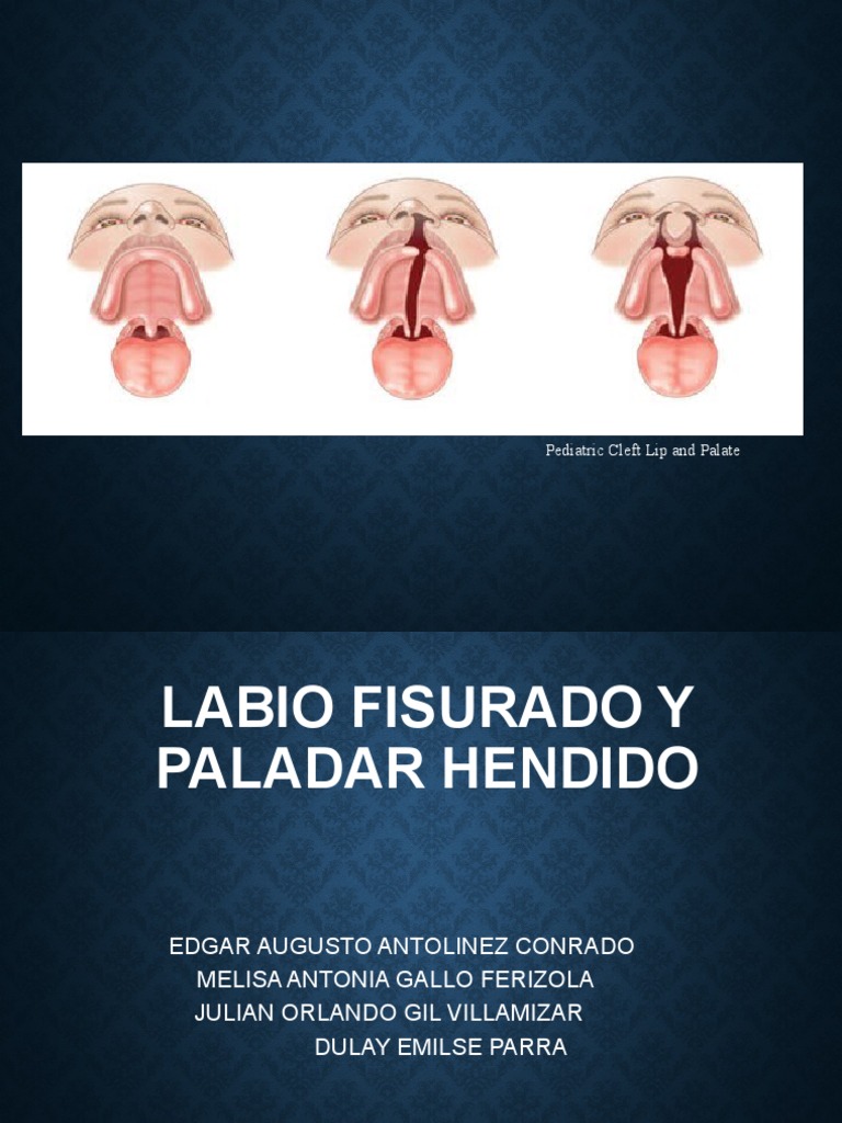 Clasificación y tratamiento del paladar hendido | PDF | Ortodoncia ...