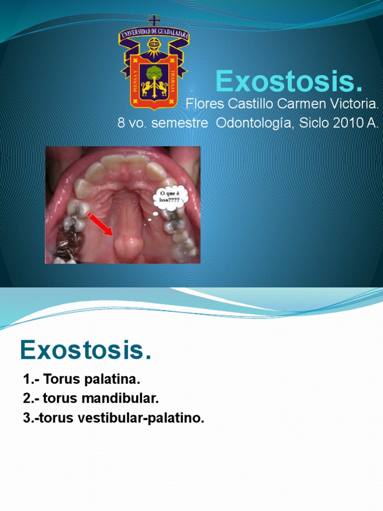 Exostosis en Odontología | PDF | Hueso | Lesión