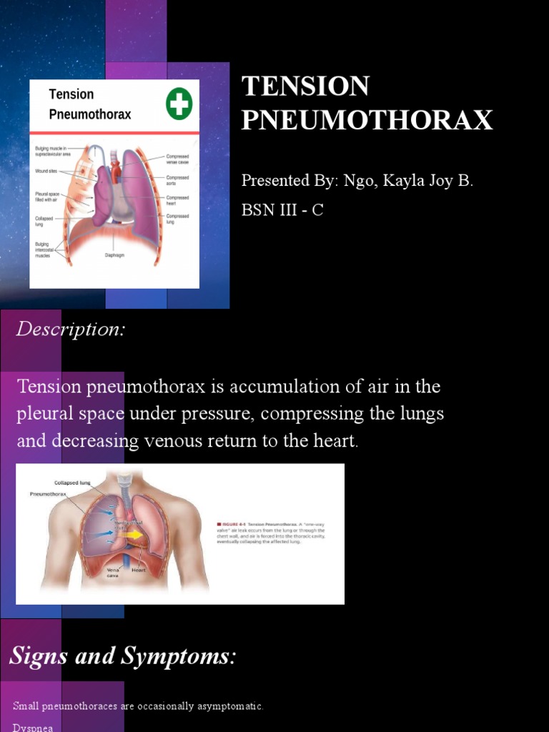 TENSION PNEUMOTHORAX - Presentation | PDF