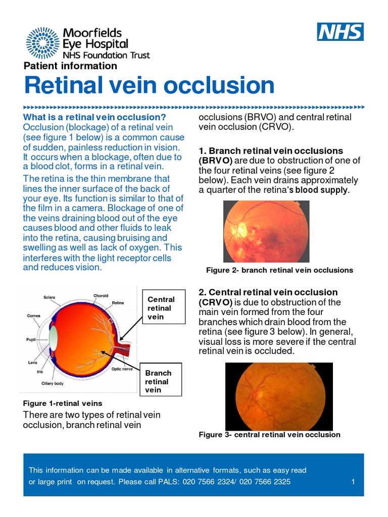 Retinal Vein Occlusion (RVO) | PDF | Retina | Medicine