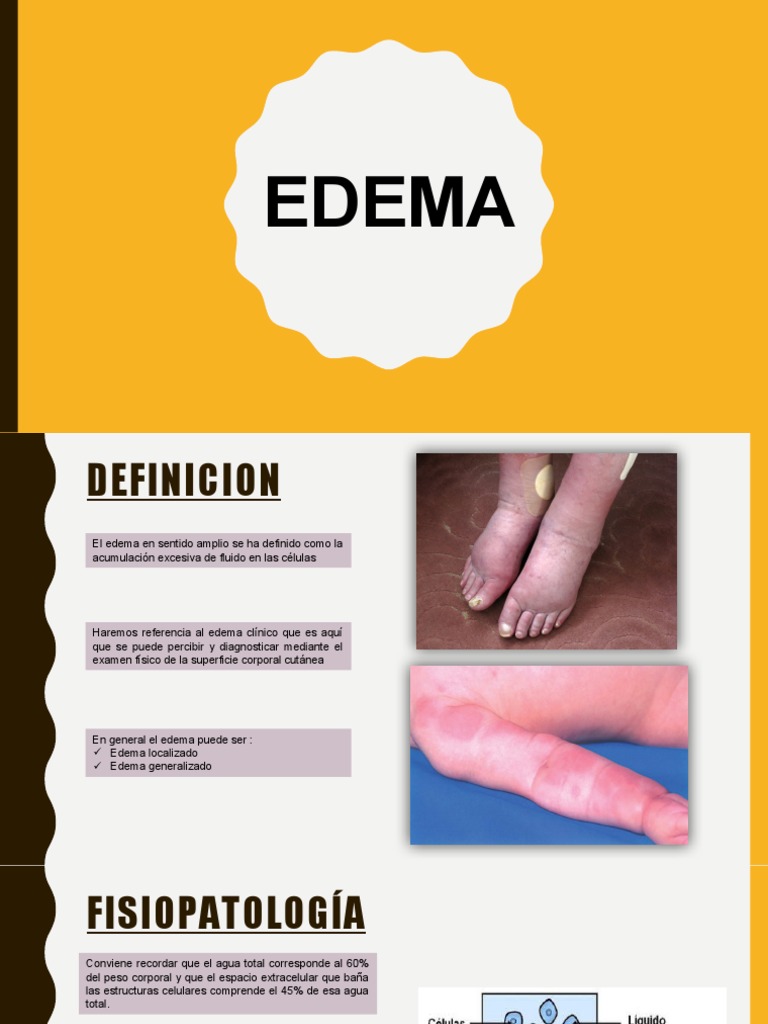 Edema: Tipos, Causas y Diagnóstico | PDF | Edema | Especialidades Medicas
