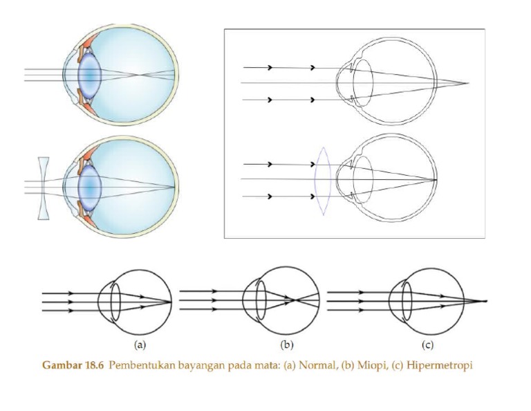 Miopi Dan Hipermetropi | PDF