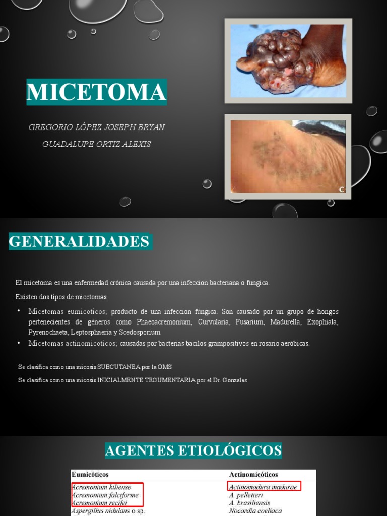 MICETOMA | PDF | Las bacterias | Inflamación