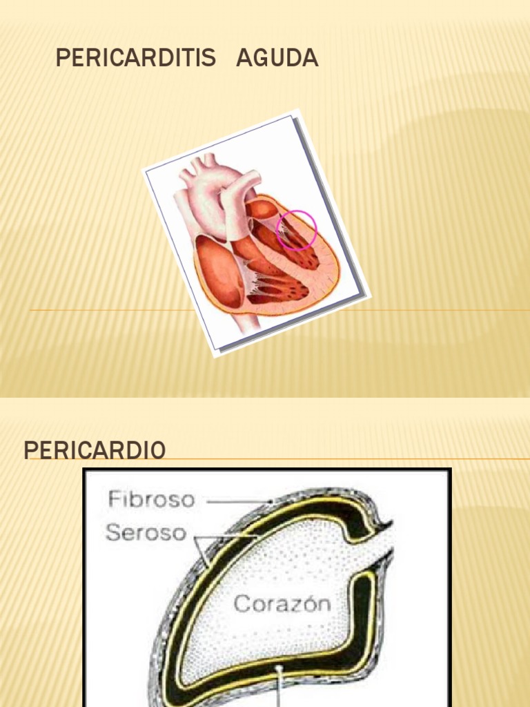 Pericarditis Aguda: Diagnóstico y Tratamiento | PDF | Enfermedades y ...