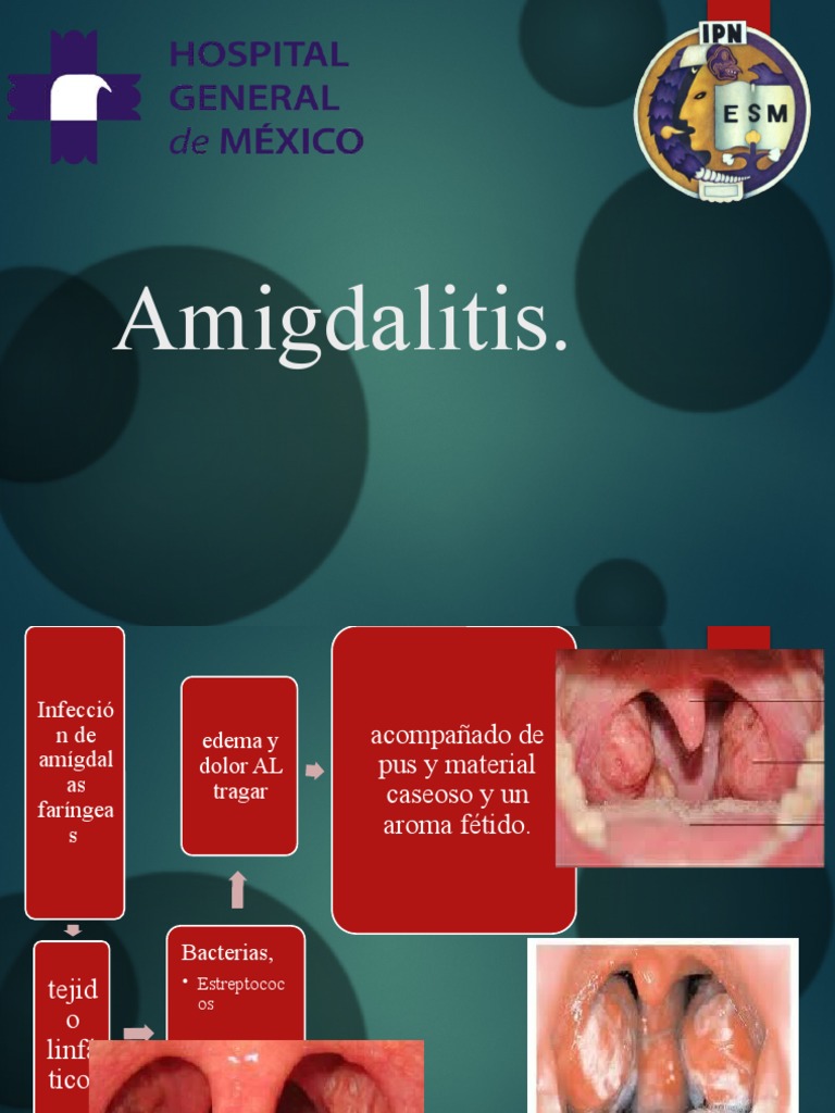 Amigdalitis | PDF | Especialidades Medicas | Enfermedades y trastornos