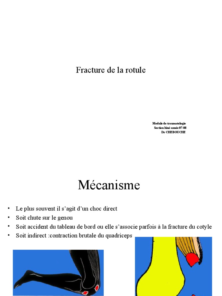 Fracture de la rotule : diagnostic et traitement | PDF | Appareil ...