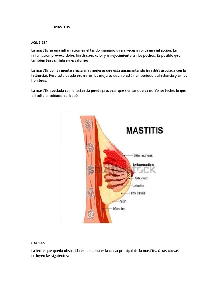 Mastitis | PDF | Pecho | Cáncer de mama