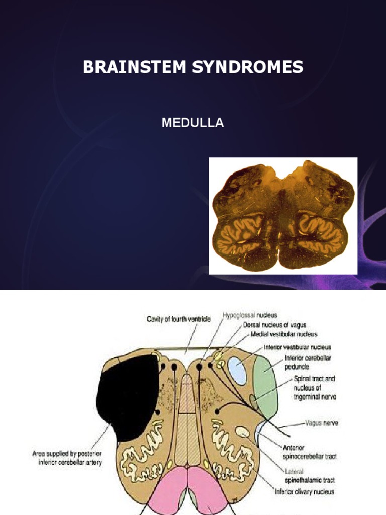 Medullary Stroke Syndromes Overview | PDF | Brainstem | Diseases And ...