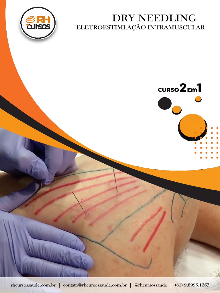 Dry Needling + Eletroestimulação Intramuscular - RH Cursos Saúde | PDF ...