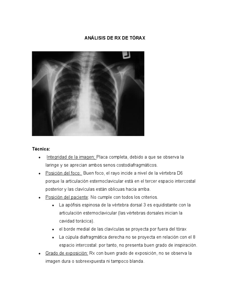 Análisis de RX de Tórax | PDF | Tórax | Pulmón