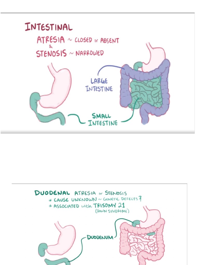 Atresia Intestine | PDF