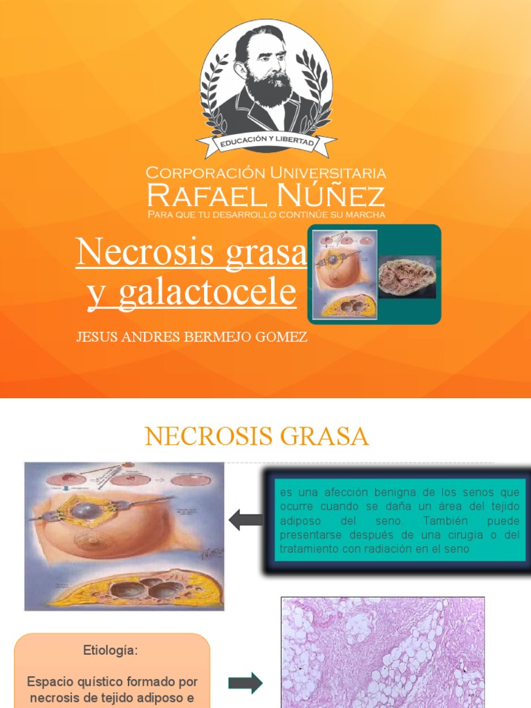 Necrosis Grasa Y Galactocele | PDF | Pecho | Órgano (anatomía)