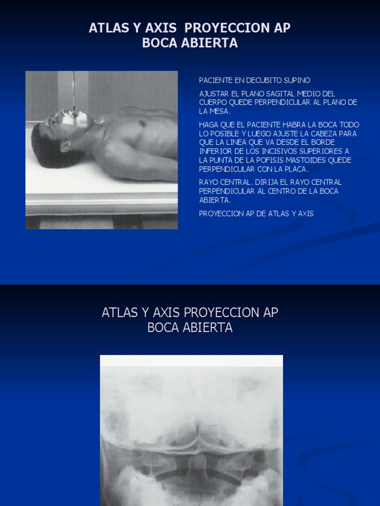 Proyección AP de Atlas y Axis | PDF | La columna vertebral | Vértebra