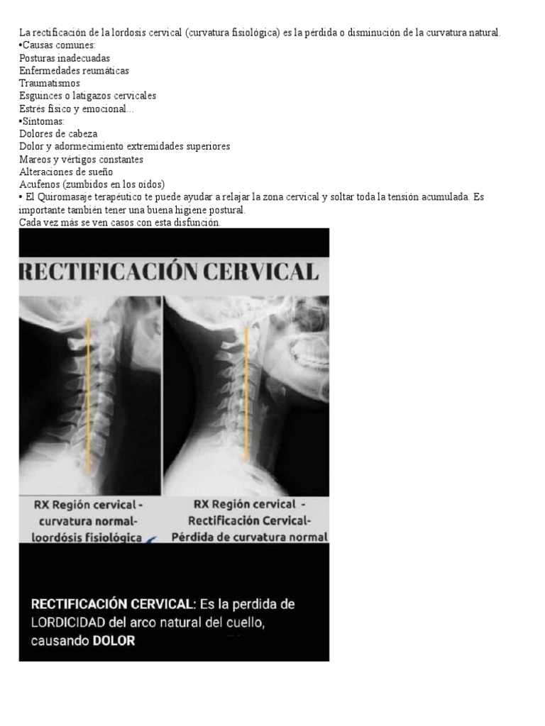 La Rectificación de La Lordosis Cervical | PDF