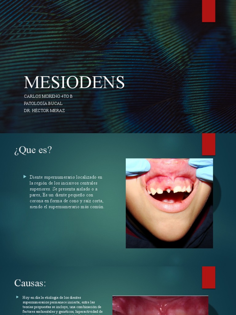 Mesiodens: Dientes Supernumerarios | PDF