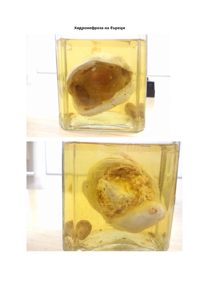 4.hidronefroza Na Babreci | PDF