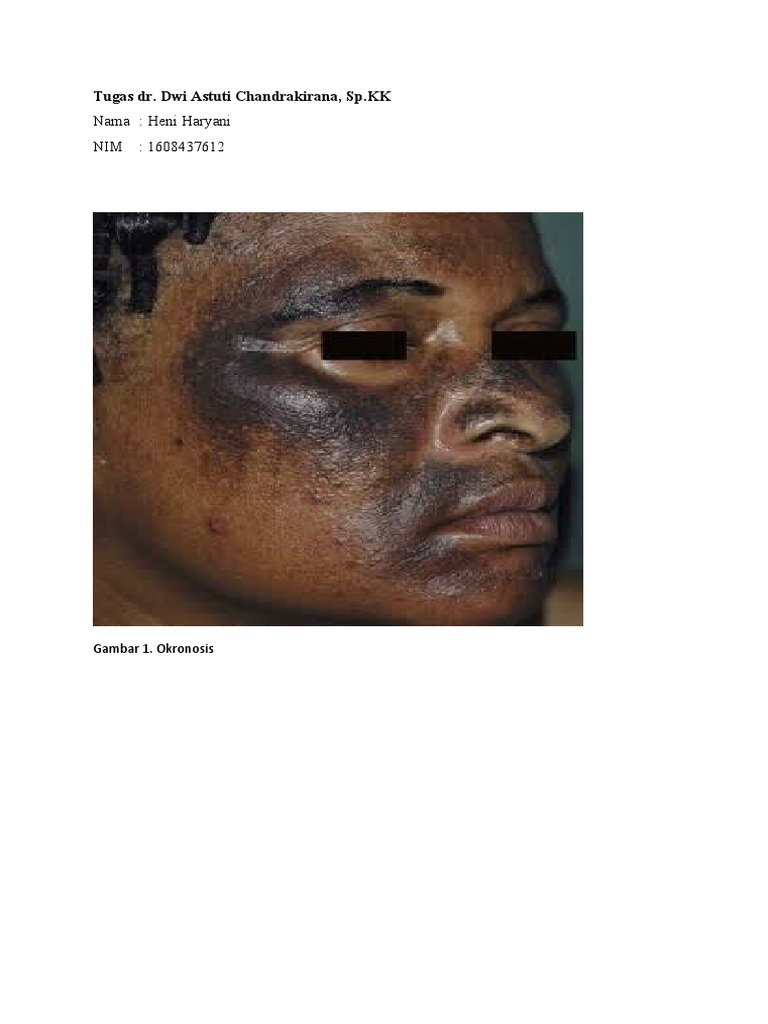 Ochronosis: Penyebab dan Penanganan | PDF