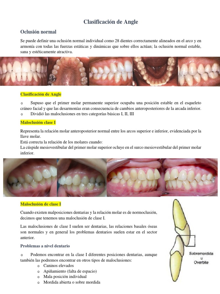 Clasificación de Angle y Maloclusiones | PDF | Boca | Diente