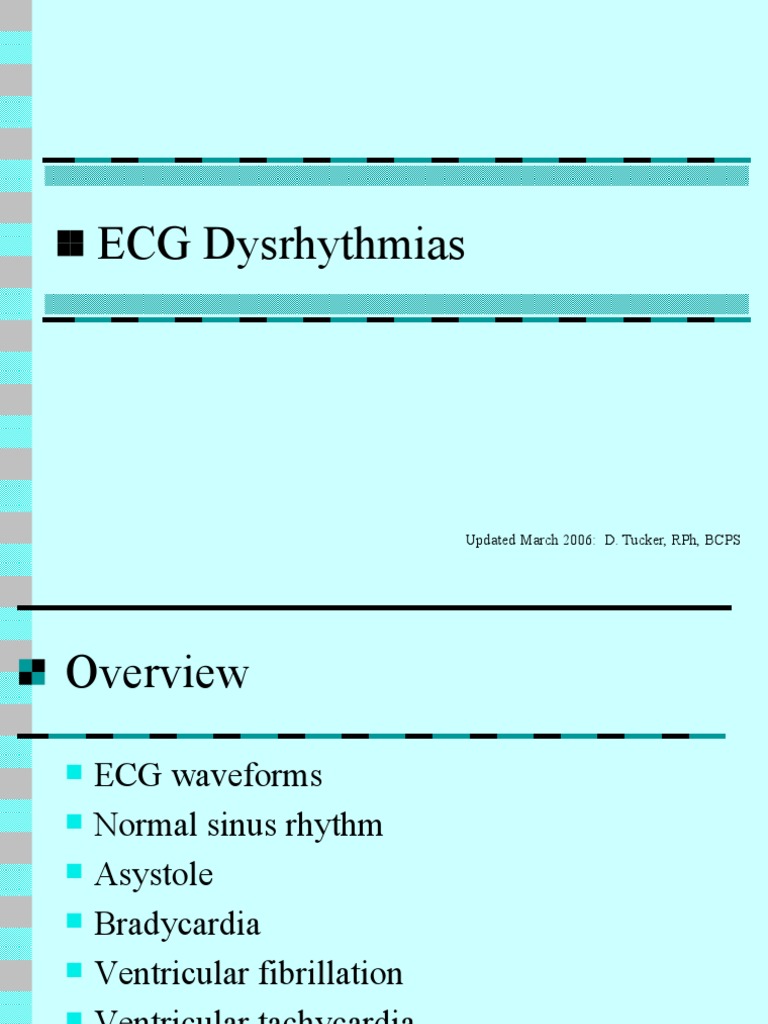 Ecg Dysrhythmias: Updated March 2006: D. Tucker, RPH, Bcps | PDF ...