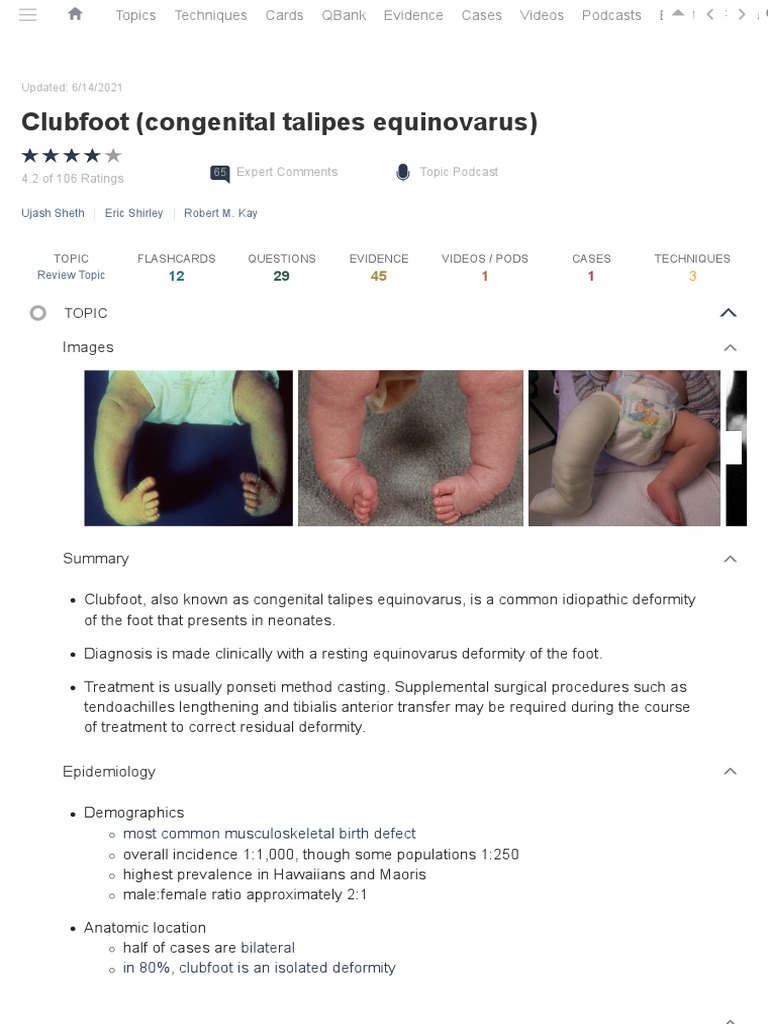Clubfoot (Congenital Talipes Equinovarus) - Pediatrics - Orthobullets ...