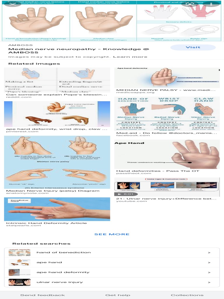 Benediction Sign Vs Claw Hand - Google Search | PDF | Young Adult