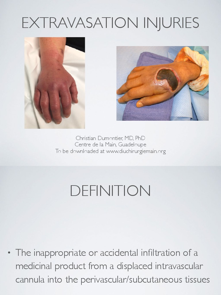 3-0 Extravasation Injuries FESSH 2022 | PDF | Intravenous Therapy ...