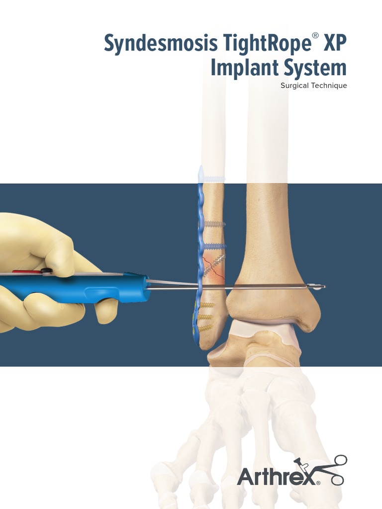 Syndesmosis Tightrope XP Implant System | PDF | Surgical Suture | Ankle