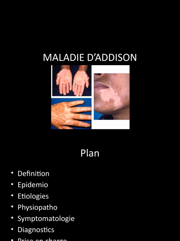 Maladie d'Addison : Symptômes et Diagnostic | PDF | Cortisol | Médecine ...