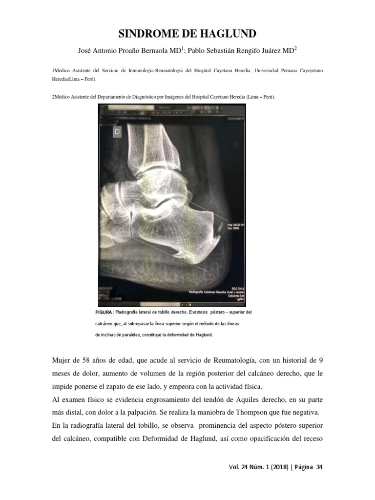 Deformidad de Haglund | PDF