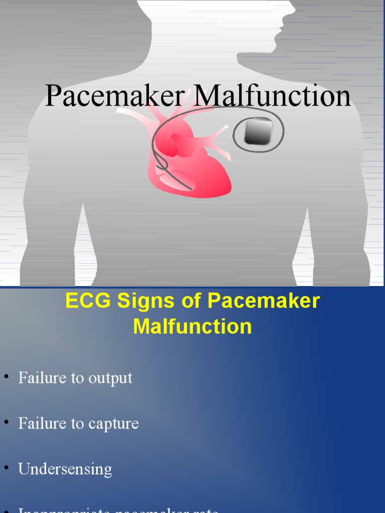Pacemaker Malfunction | PDF | Artificial Cardiac Pacemaker ...