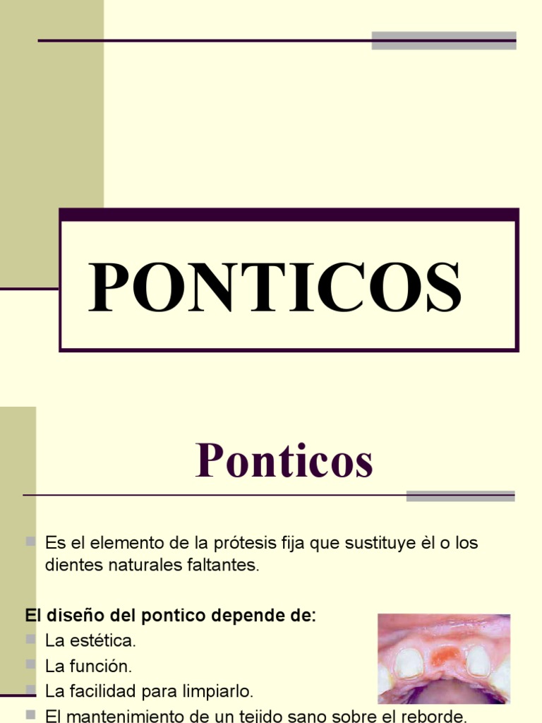 Tipos y Diseño de Pónticos Dentales | PDF | Dentadura postiza | Diente