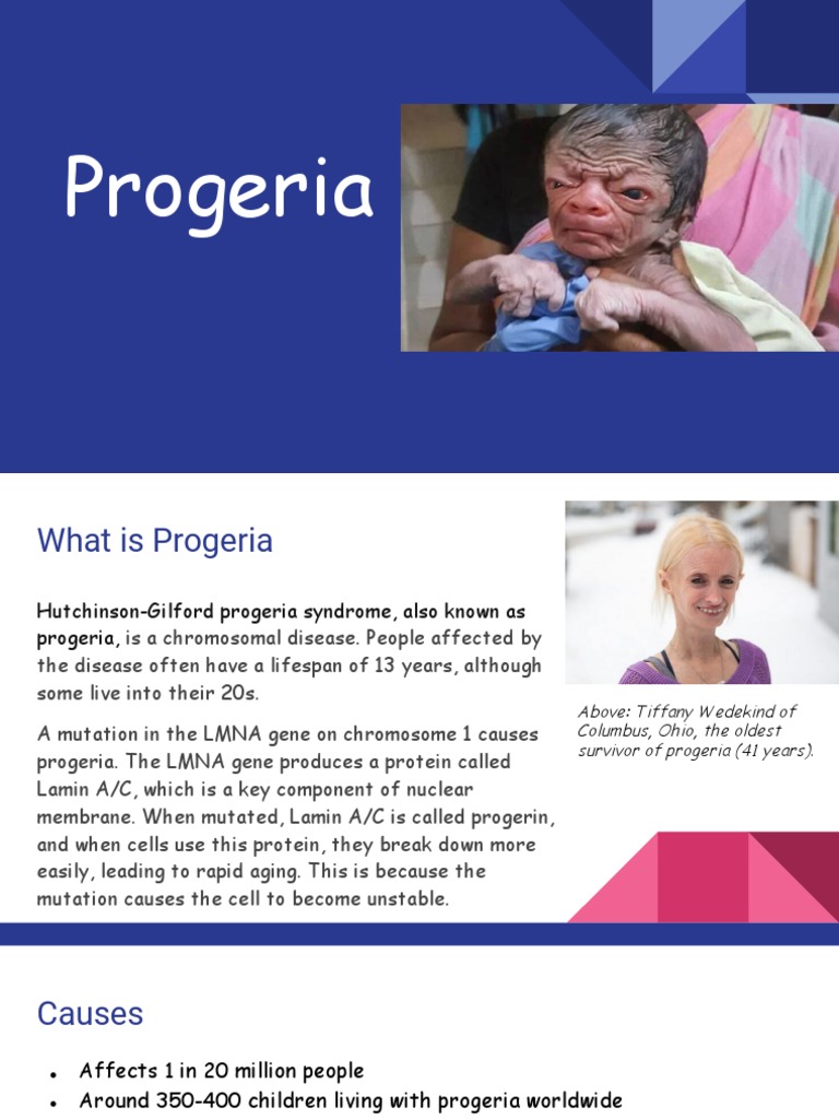 Progeria | PDF | Diseases And Disorders | Clinical Medicine