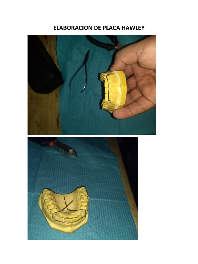 Elaboracion de Placa Hawley | PDF