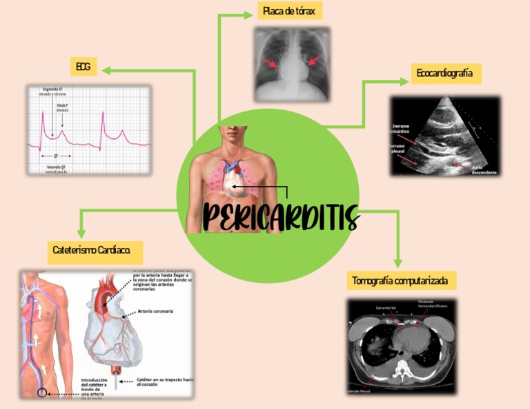 Pericarditis Mapa Mental | PDF