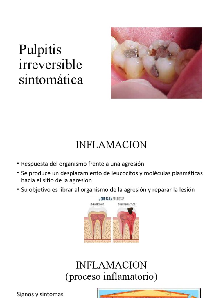 Pulpitis Irreversible Sintomática | PDF | Inflamación | Sistema inmune