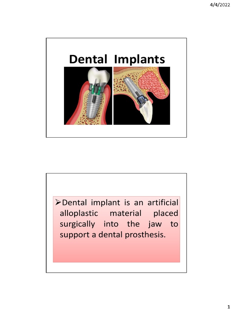 Dental Implants | PDF | Dental Implant | Dentistry Branches