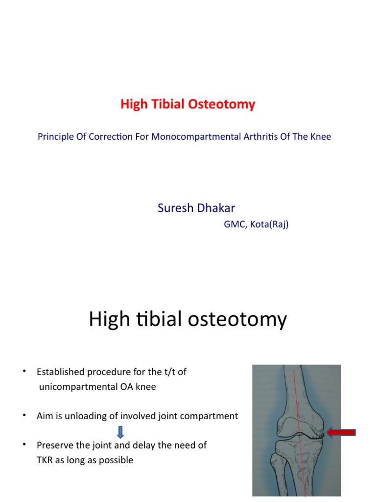 High Tibial Osteotomy: Suresh Dhakar | PDF | Knee | Oral And ...