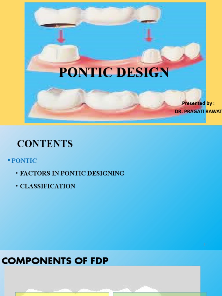 Factors to Consider in Pontic Design for Successful Fixed Dental ...