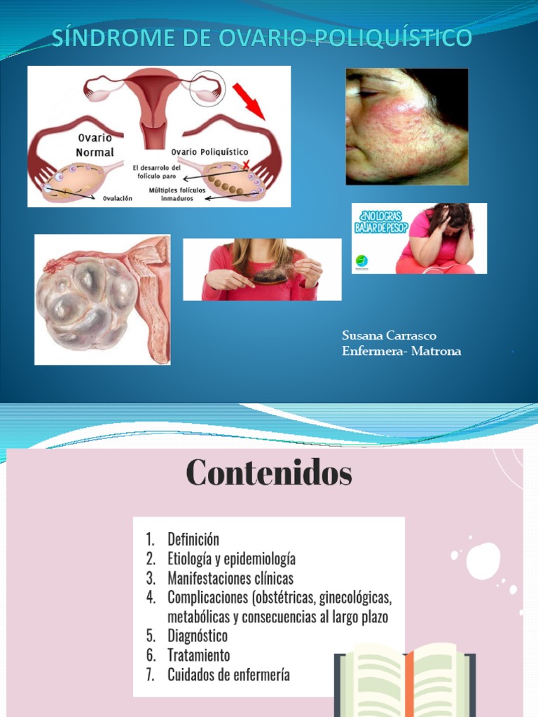 Sã Ndrome de Ovario Poliquã Stico 2022 | PDF | Especialidades Medicas | Medicina