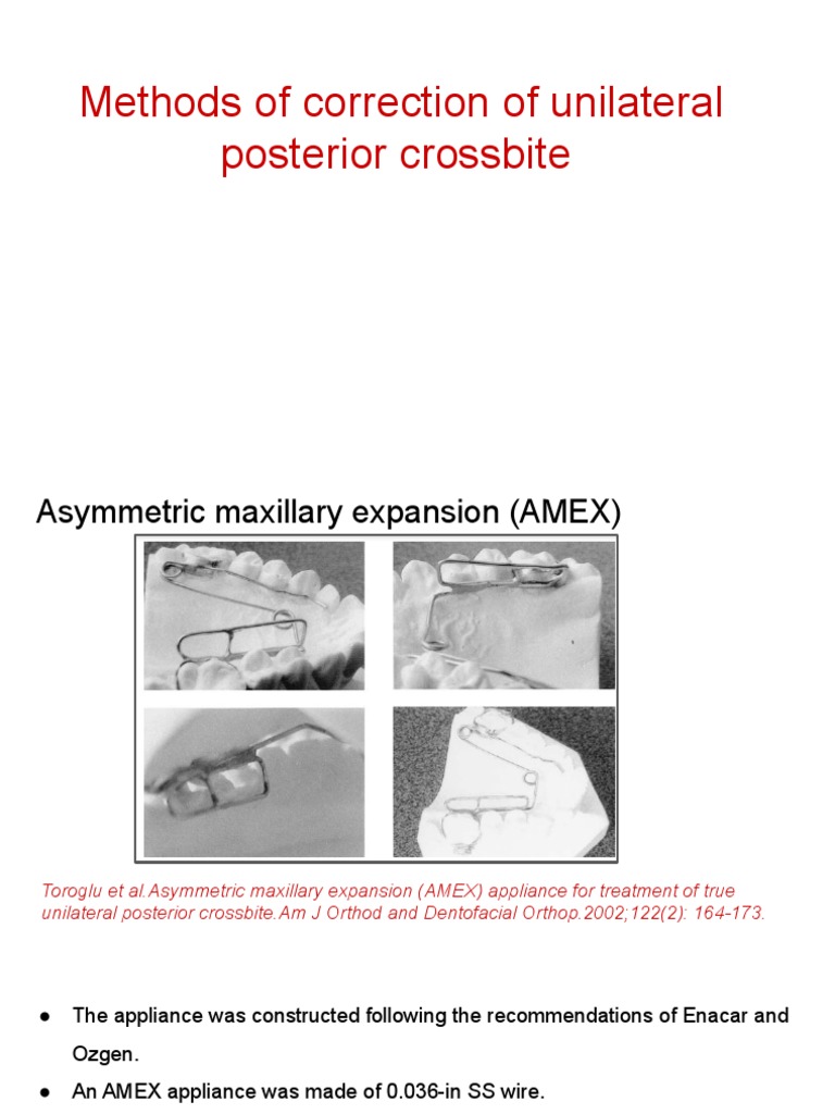 Methods of Correction of Unilateral Posterior Crossbite | PDF ...