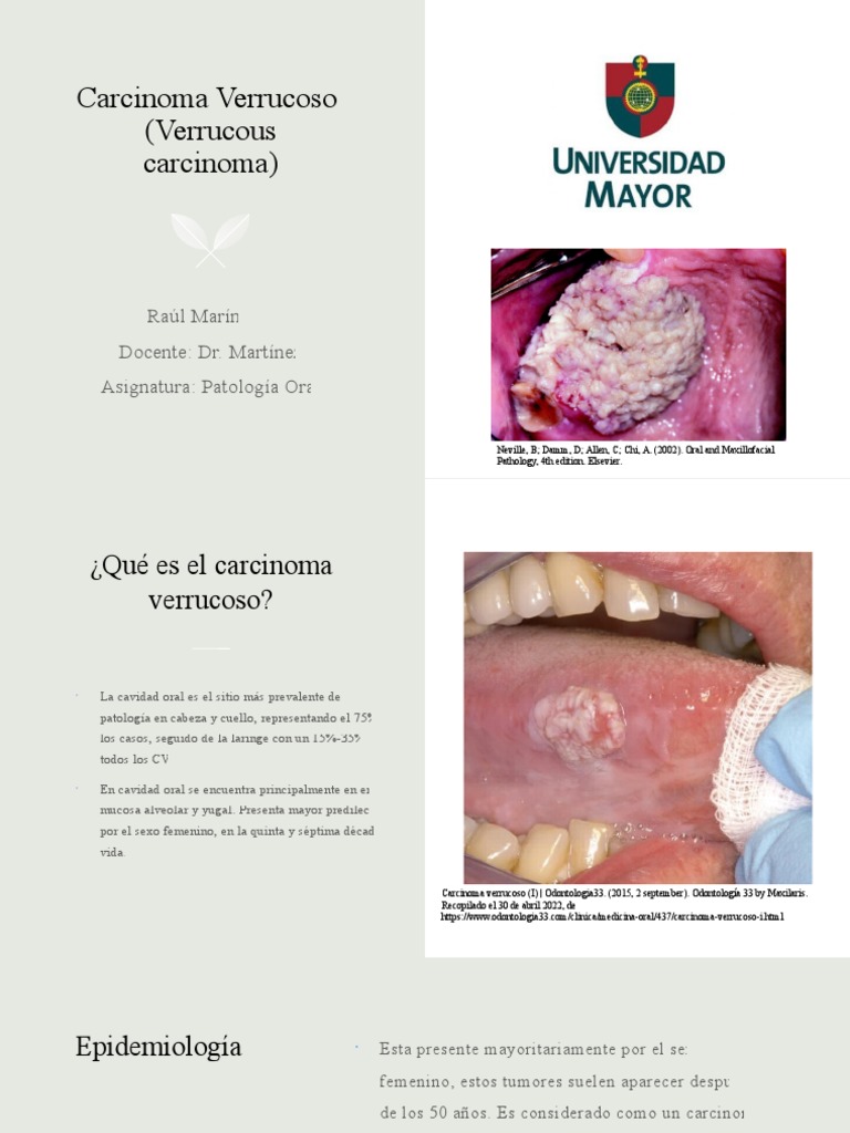 Carcinoma Verrucoso | PDF | Epidemiología | Medicina