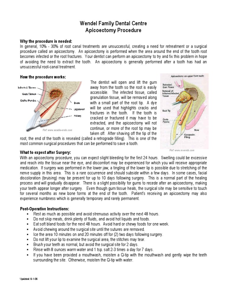 Apicoectomy Final | PDF | Surgery | Dentistry
