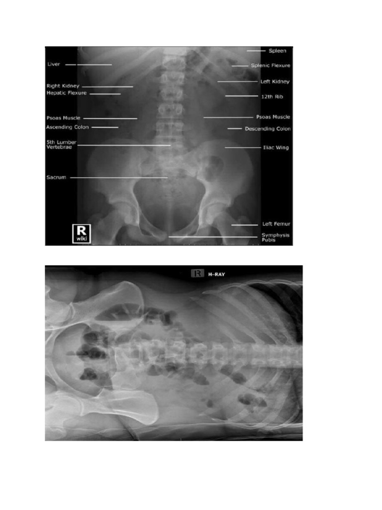 PNEUMOPERITONEUM | PDF