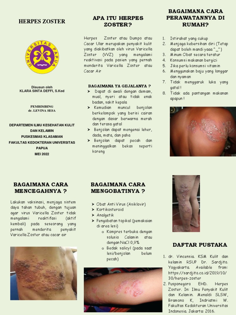 Leaflet - Herpes Zoster - Doc | PDF